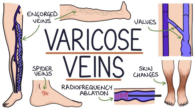 Treatment of Varicose Veins (Endovenous Ablation of Varicose Veins ...